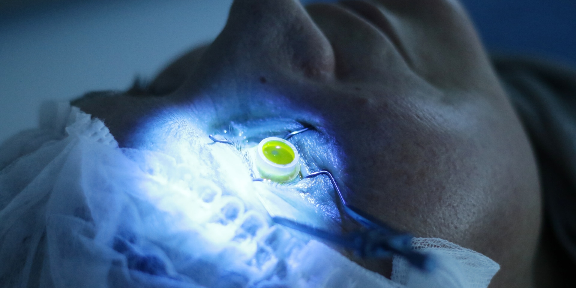 Úlcera Corneal Síntomas Y Tratamiento Blog De Oftalmosalud