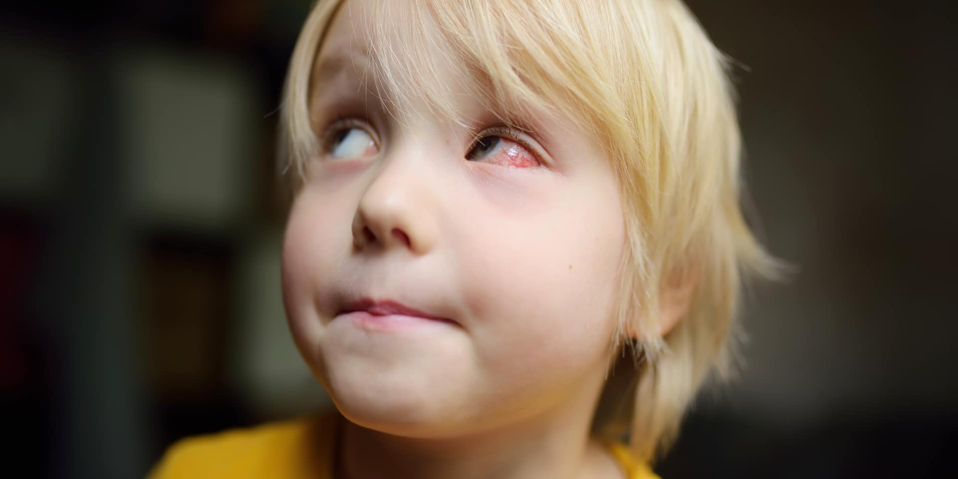 Orzuelo: ¿por qué aparece y cómo se trata? | Blog de OftalmoSalud