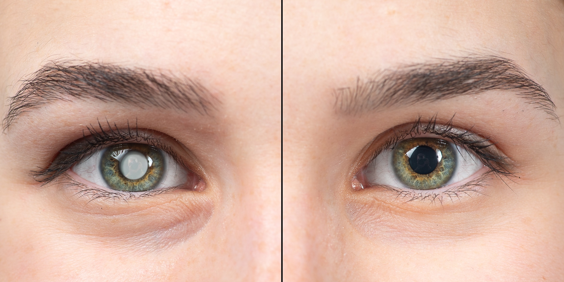 Cirugía de estrabismo: ¿Cómo es la operación? | Blog de OftalmoSalud