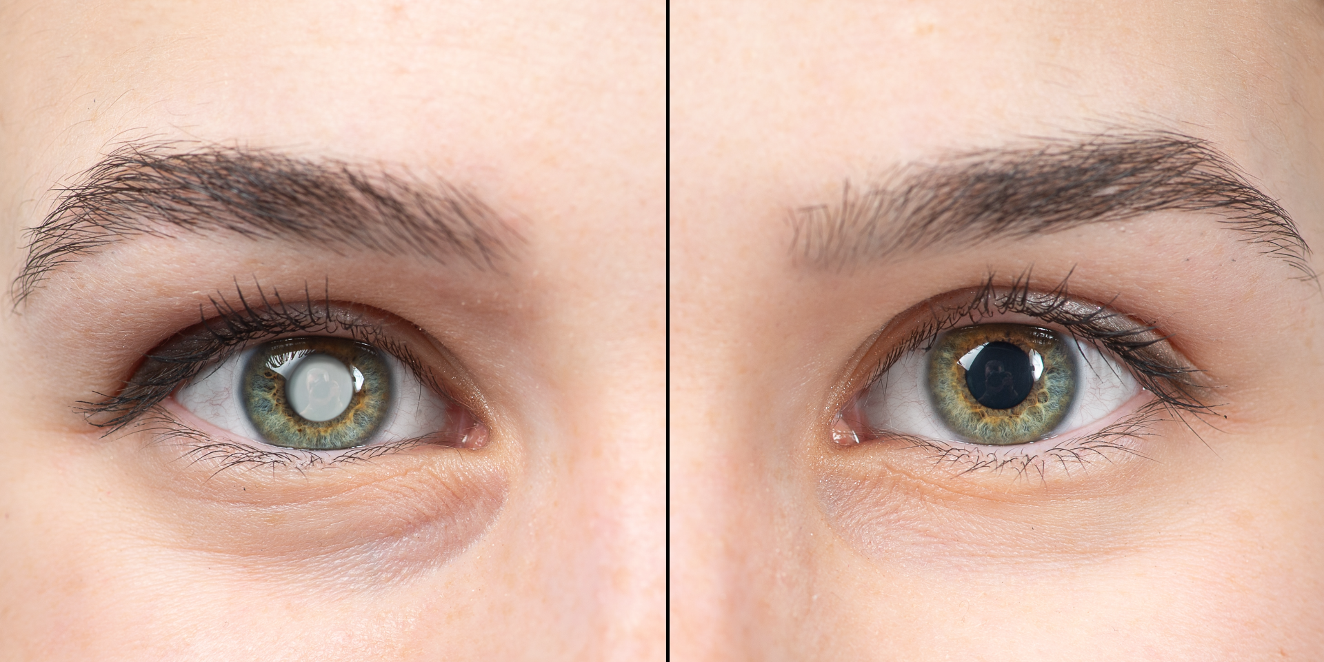 ¿Qué es una catarata nuclear y cómo tratarla? | Blog de OftalmoSalud