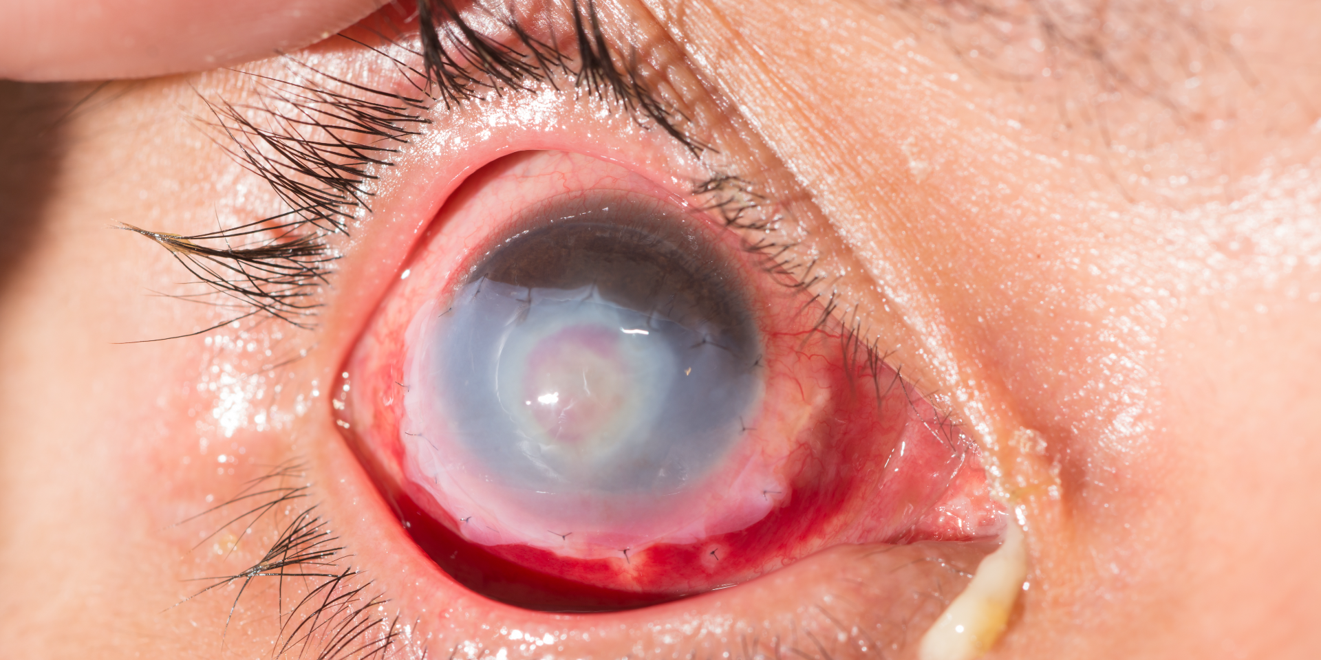 Trabeculoplastia láser para glaucoma | Blog de OftalmoSalud