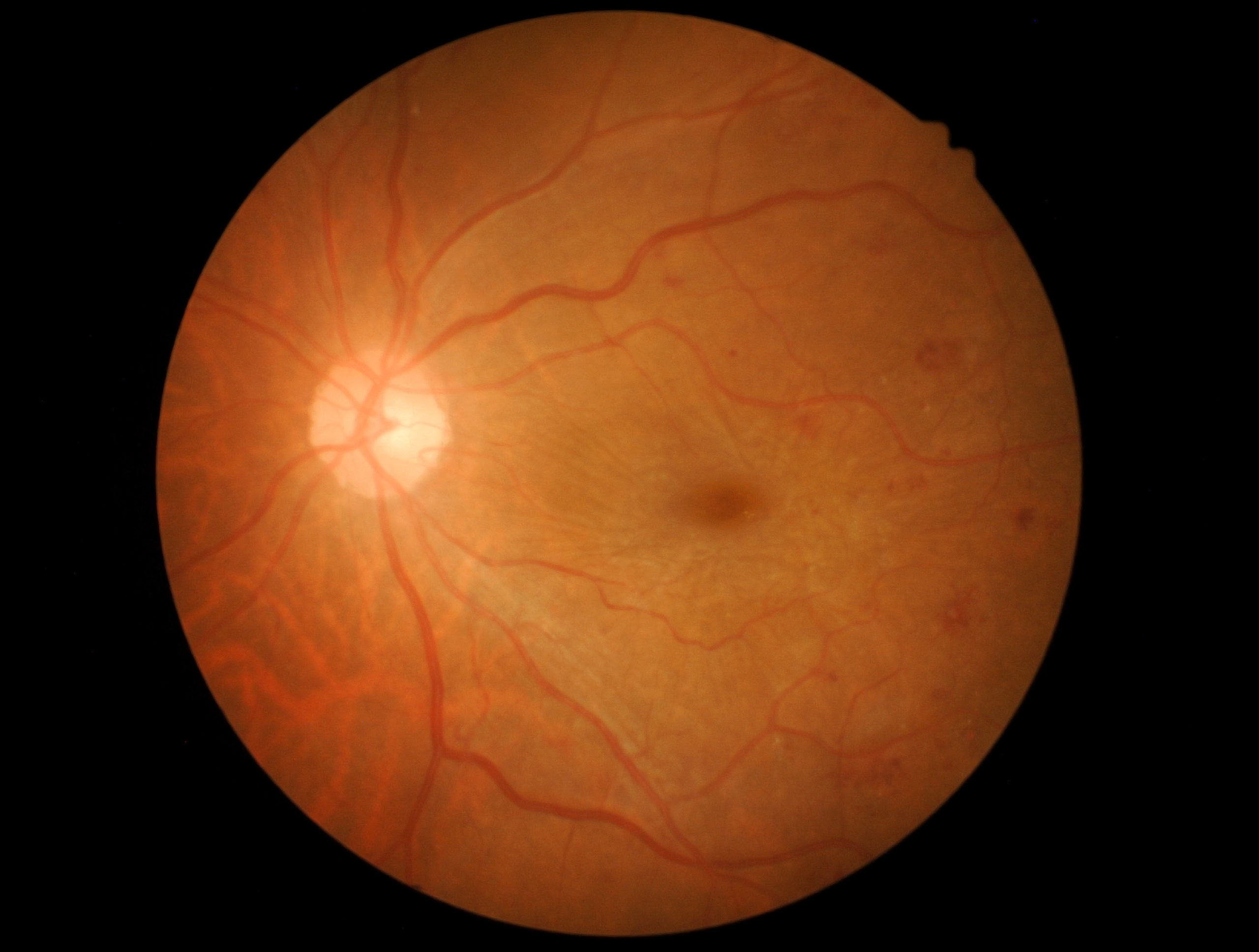 Canal de Schlemm: Anatomía, función y su impacto en la salud ocular | Blog de OftalmoSalud