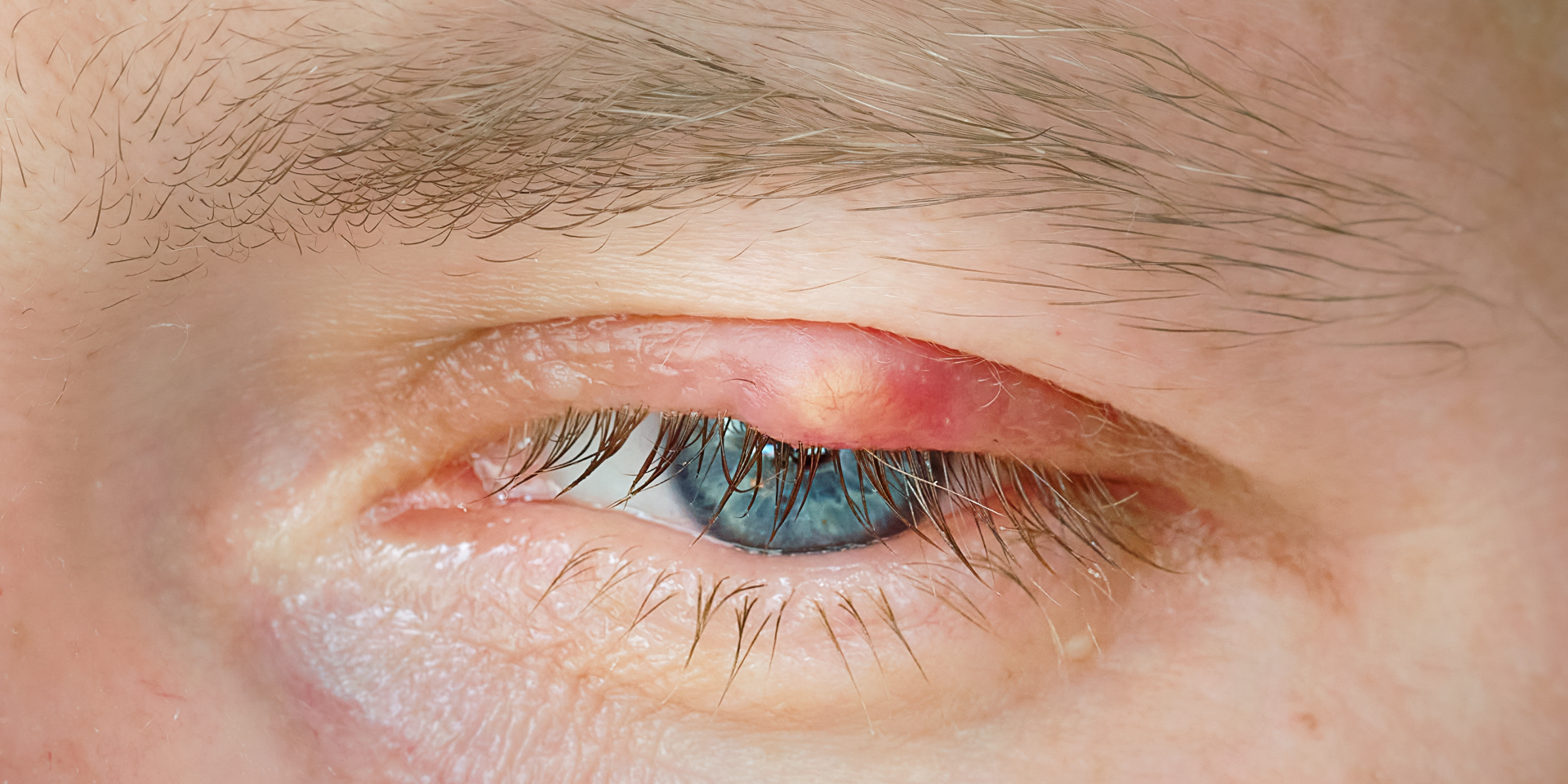 Demodex: los ácaros que viven en tus pestañas | Blog de OftalmoSalud