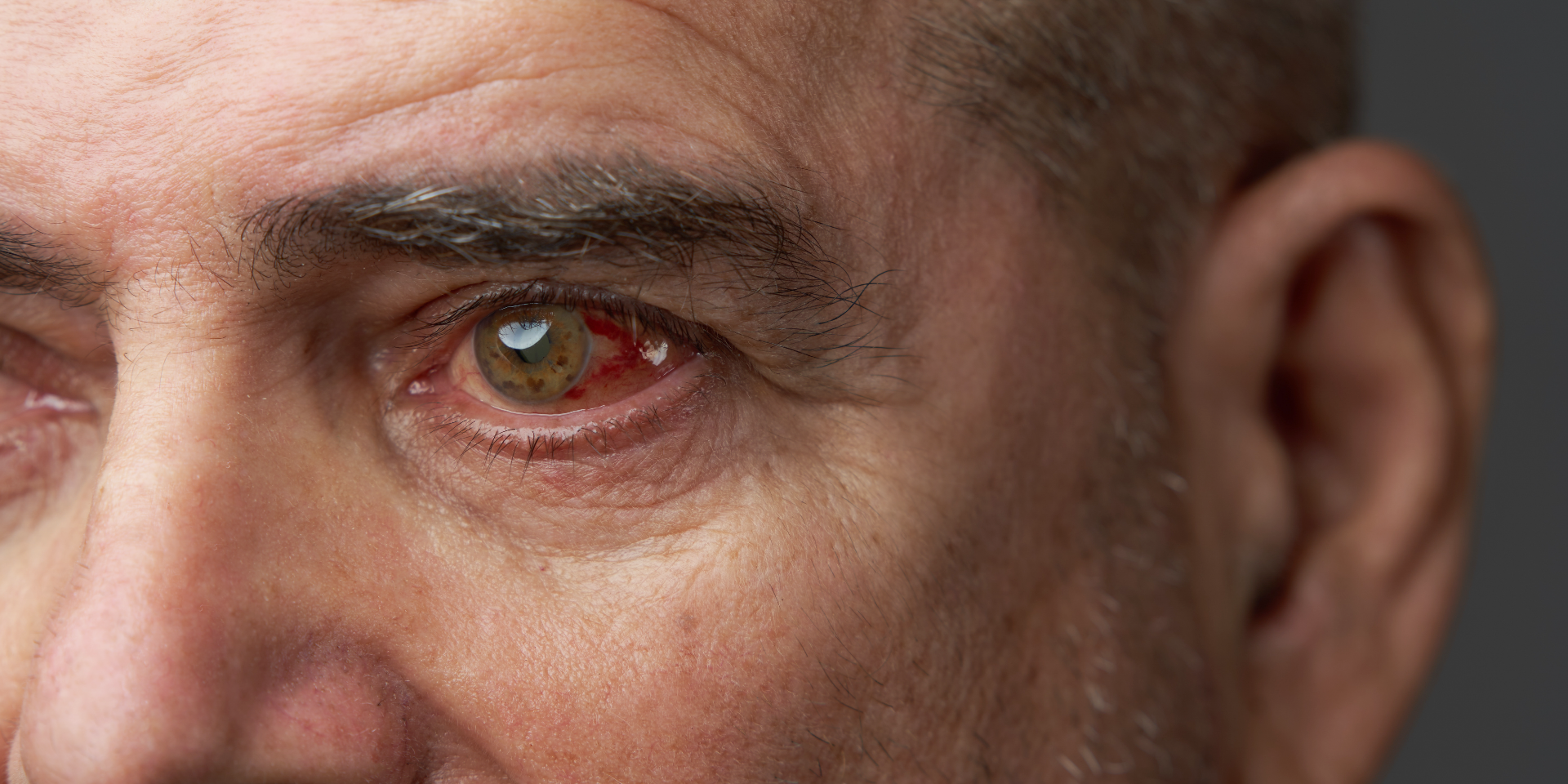 Derrame ocular: causas y tratamiento | Blog de OftalmoSalud